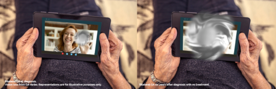 Update: First Treatments for Advanced Dry AMD - OE Patients